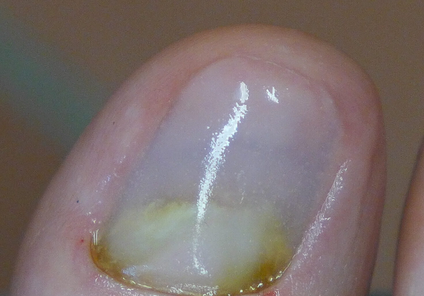 Prothetik (Nagelersatz) – Fussimpuls • Fußpflegepraxis in privater ...